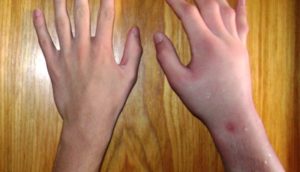 Bee Sting 101: Easy Guide on How to Deal with Bee Stings